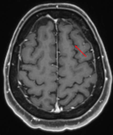 Sulcus Frontalis Superior Ars Neurochirurgica