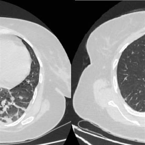 Thoracic Ct Scan Showed Lesions Compatible With A Sars Cov 2 Infection Download Scientific