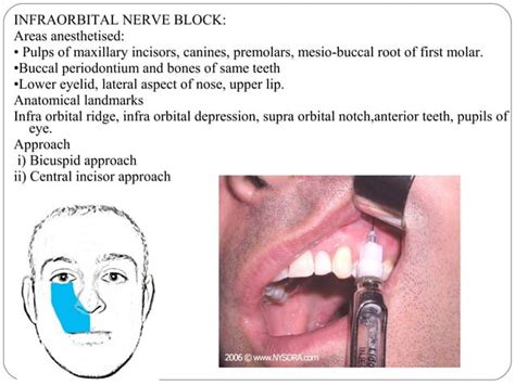 Maxillary Injection Techniques Ppt