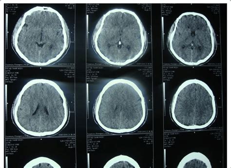 Brain Ct Scan In Case 2 Showing Brain Edema Download Scientific Diagram
