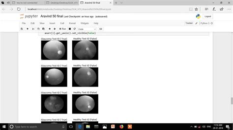 Automated Detection Of Glaucoma Using Deep Neural Network Youtube