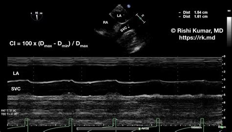 superior vena cava svc collapsibility index ci rk md