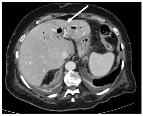 Lobar And Segmental Atrophy Of The Liver Differential Diagnoses And