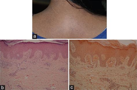 Clinicopathological Correlation Of Acquired Hyperpigmentary Disorders