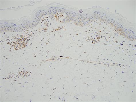 Cell Poor Interface Dermatitis Of Systemic Lupus Erythematosus Dermatopathology