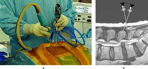 Endoscopic Lumbar Discectomy Disc Herniation At Aidan Zichy Woinarski Blog