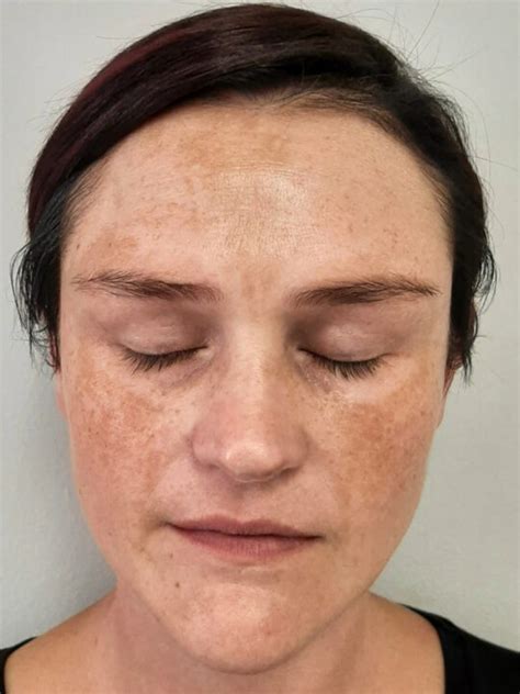 Lourette Du Toit On Linkedin Bblexperts Skin Aesthetics Medical Laser Peels Ingredients