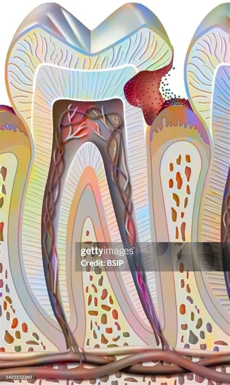 Tooth Decay Drawing High Res Vector Graphic Getty Images