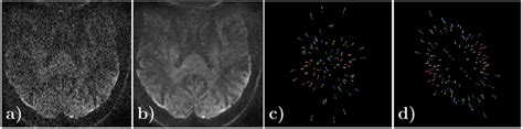Diffusion Weighted Data S G A Slice Of Diffusion Weighted Image For A Download Scientific