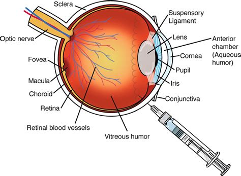 Intravitreal Injections Retina Center Of San Diego