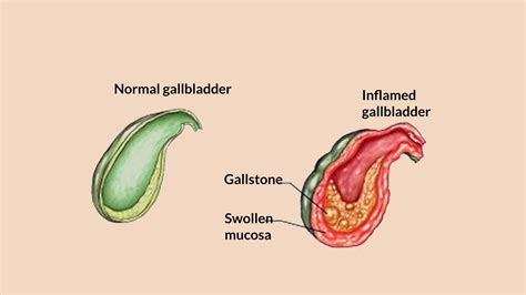 Acute Cholecystitis