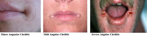 What Is Angular Cheilitis Symptoms Types Causes Chronic Treatments Preventions And