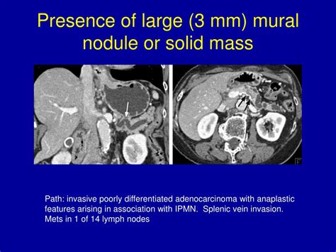 PPT - Intraductal Papillary Mucinous Neoplasms PowerPoint Presentation - ID:4265826
