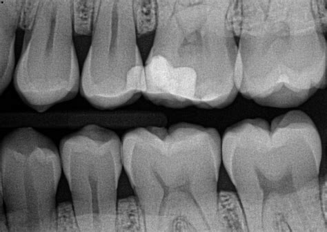 Caries Detection Bsxsj Object Detection Dataset By Vazgen Hakobjanyan