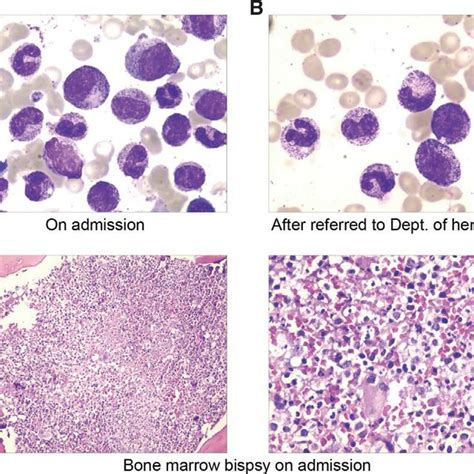 Cytological Analysis Of Bone Marrow Samples A Hematoxylin And Eosin
