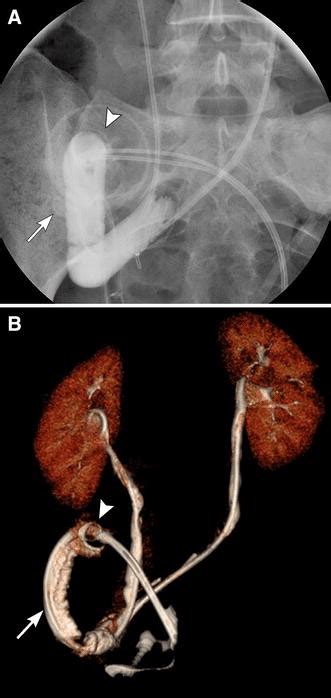 1a Contrast Loopogram Demonstrates Normal Ileal Conduit Arrow With