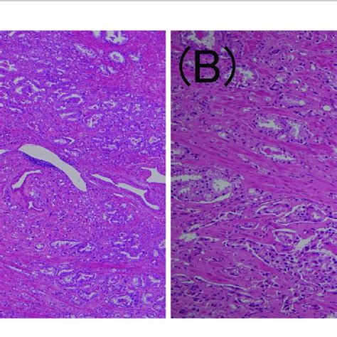 Pdf Clinicopathological Analysis Of The Isup Grade Group And Other Parameters In Prostate