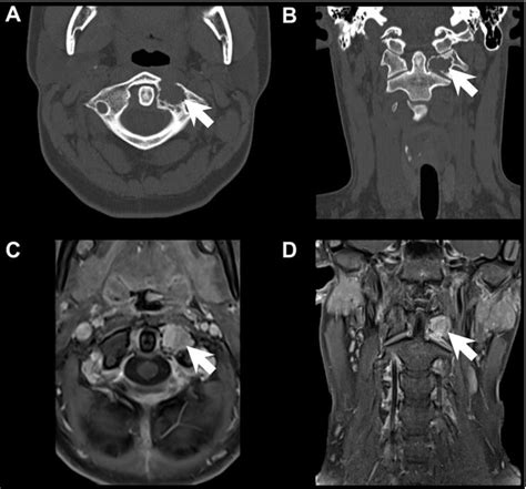 What Are Lateral Masses At Conrad Williams Blog