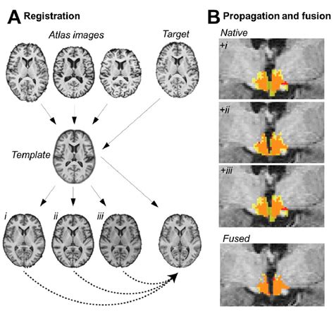 multi atlas fusion segmentation for automated hypothalamus