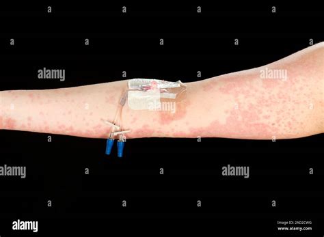 Epstein Barr Virus Infection Close Up Of A Cannula In The Arm Of A 19