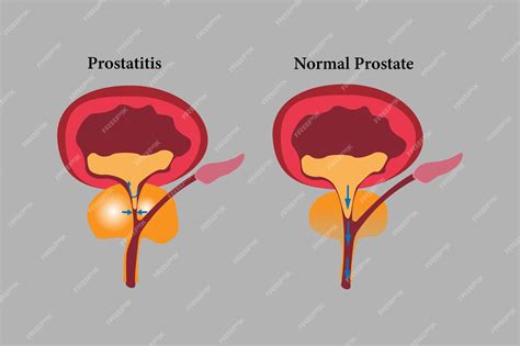 Premium Vector Comparation Of Health Prostate And Unhealth Prostate
