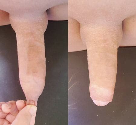 Korean Uncut Cock Foreskin On Off Pics XHamster