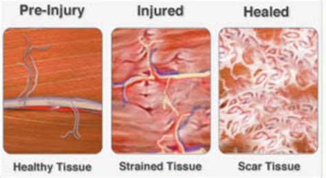 Scars And Their Negative Impact Deep Physio