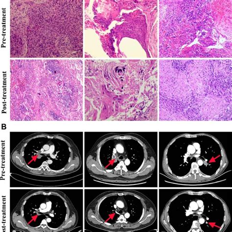 Radiographic Pathologic And Molecular Response Characteristics