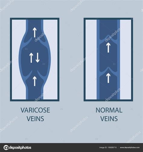 Векторна ілюстрація варикозної вени та нормальної вени Стоковий вектор ©antaya 159285710