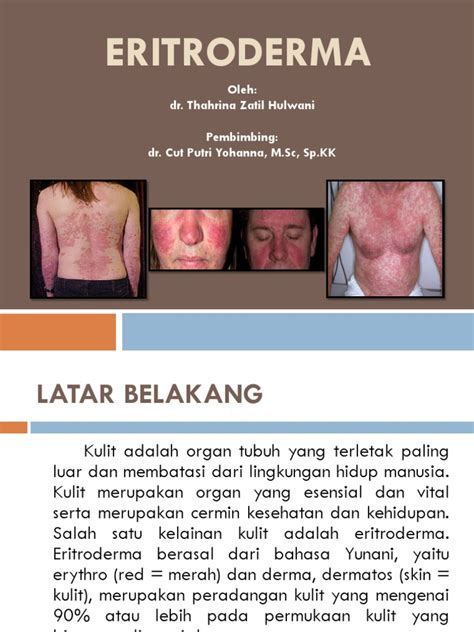 Eritroderma Pdf