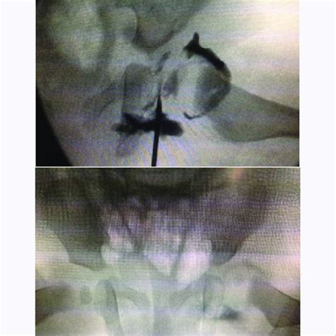 B Left Hip Arthrogram And Closed Reduction Were Performed Under General