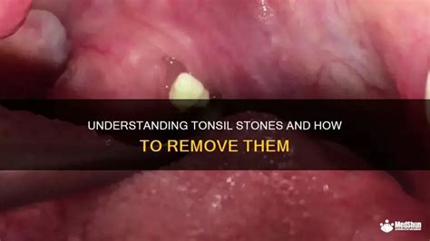 Understanding Tonsil Stones And How To Remove Them Medshun