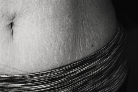 Can A Tummy Tuck Get Rid Of Your Stretch Marks Dr Lee B Daniel