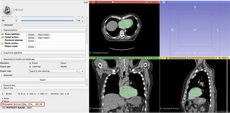 Dicom Rt Struct在python中显示mask以及使用3d Slicer转换为niirtstruct吨吨不打野的博客 Csdn博客