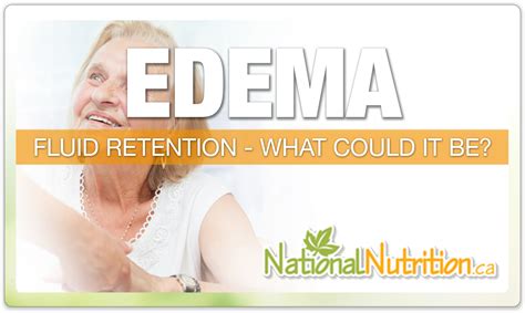 Edema Causes Treatment And Management National Nutrition Article