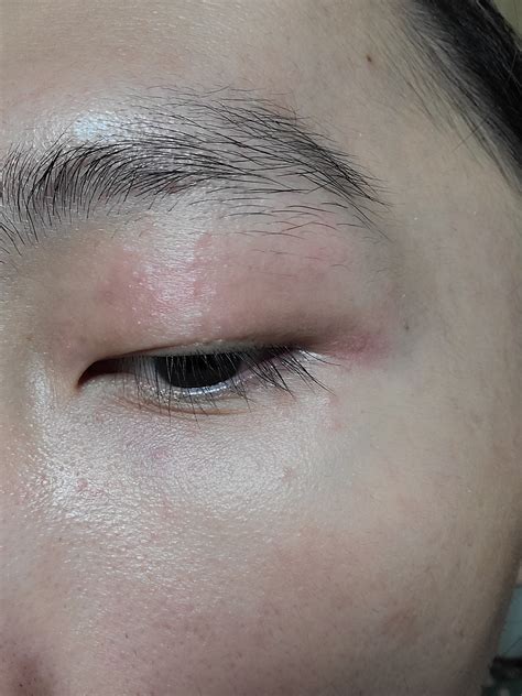 눈주위 두드러기 병원가야할까요 ㅣ 궁금할 땐 아하