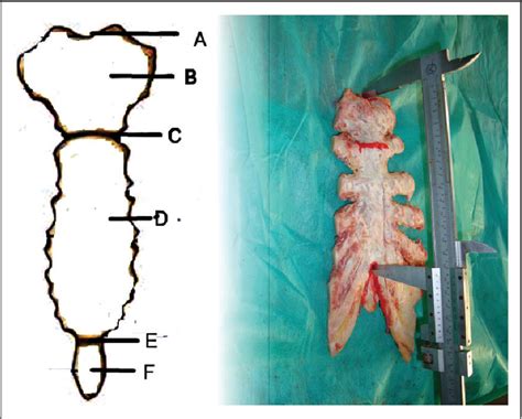 Figure 1 From Estimation Of Height From The Length Of The Sternum In An Adult Indian Population