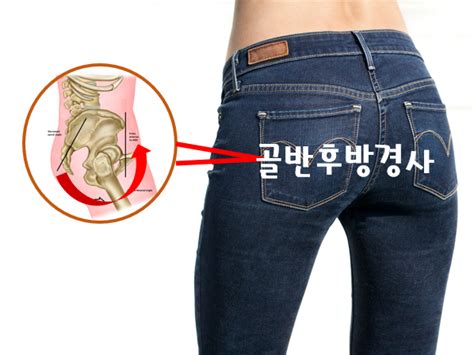 골반 후방 경사 교정운동 처진 엉덩이 네이버 블로그