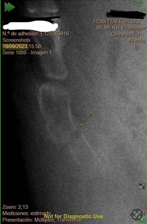 Post Birth Tailbone Fracture Rradiology