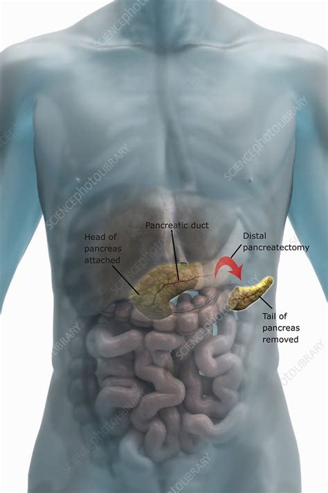 Distal Pancreatectomy Artwork Stock Image C020 4727 Science Photo Library