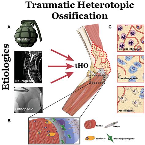 Heterotopic Ossification And The Elucidation Of Pathologic