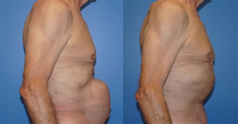 Hernia Repair And Abdominal Wall Reconstruction Abdominal Wall