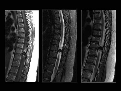 Facet Joint Hypertrophy Mri At Marcus Hanger Blog