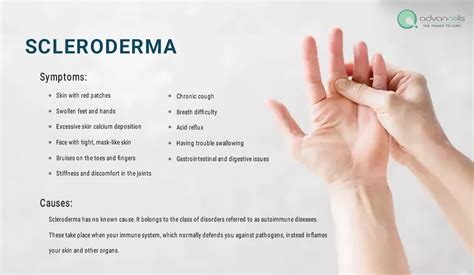 Scleroderma Symptoms Causes Types Diagnosis And Treatment