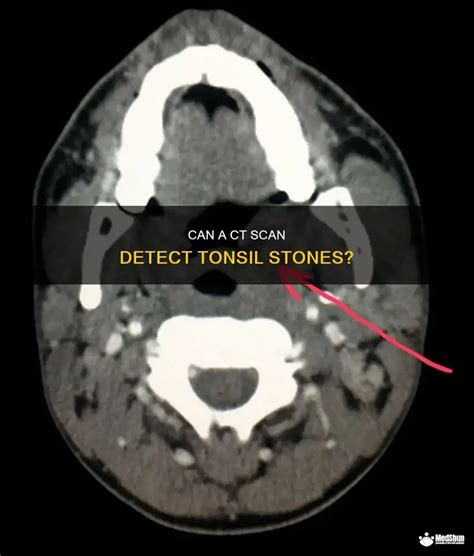 Can A Ct Scan Detect Tonsil Stones Medshun