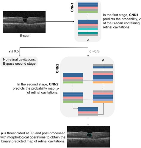 Deep Learning Based Classification And Segmentation Of Retinal Cavitations On Optical Coherence