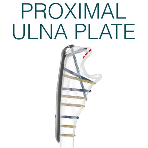 Skeletal Dynamics On Linkedin Proximal Ulna Plate Designed To Effectively Fix The Proximal