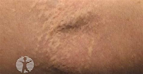 Pseudoxanthoma Elasticum Image