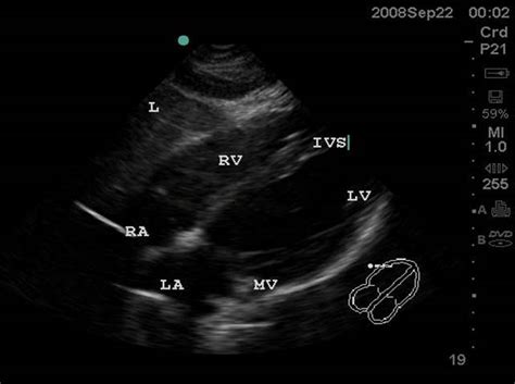 Subxiphoid Ultrasound