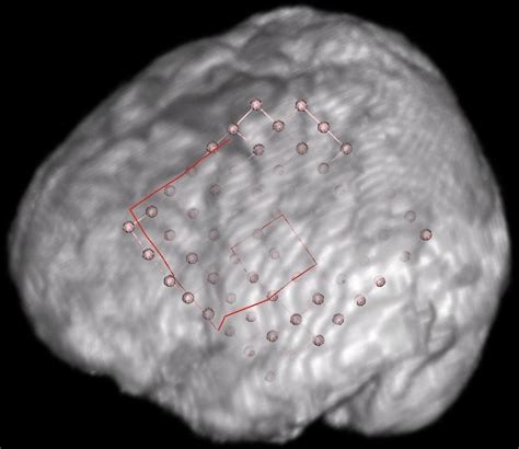 Voxel Based Morphometry Of Adhd In New Onset Pediatric Epilepsy